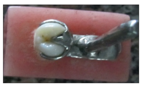 Evaluation of Acetal Resin and Cobalt-Chromium Clasp Deformation and ...